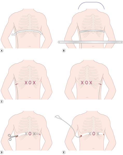 Chest Wall Deformities Clinical Tree