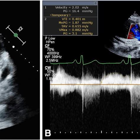 A Two Dimensional Tte Apical Four Chamber View Systolic Frame
