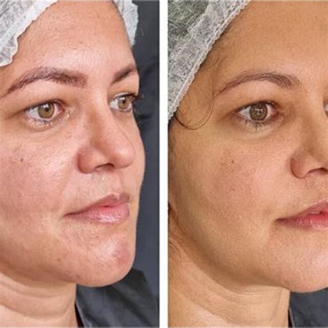 Left Photograph Showing Microfocused Ultrasound Mfu And Barbs Pdo