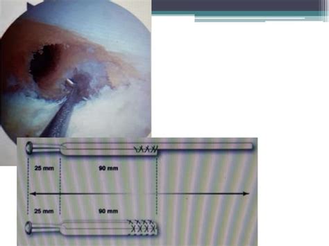 Acl Reconstruction Quadrapled Hamstring Graft Pptx