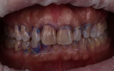 3d Printed Veneers Used For Tetracycline Staining Clinical Case
