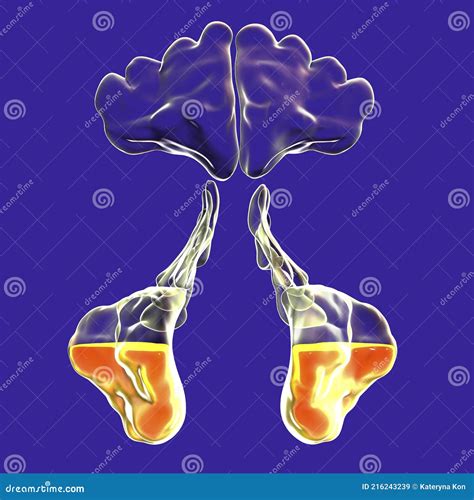 Inflammation I Maxillary Cavity Eller Antrum Of High More Stock