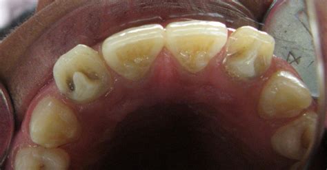 Bilateral Dens Evaginatus Talon Cusp In Permanent Maxillary Lateral