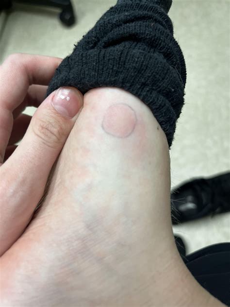 Bug Bite Identification Rbugidentification