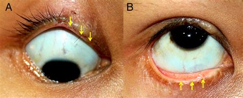 Junctional Nevus Eyelid