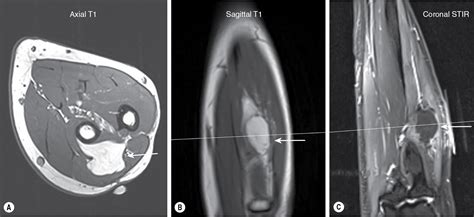 Radial Nerve Decompression Clinical Tree