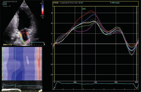 Two‐dimensional Speckle Tracking Imaging In The Apical Two‐chamber View