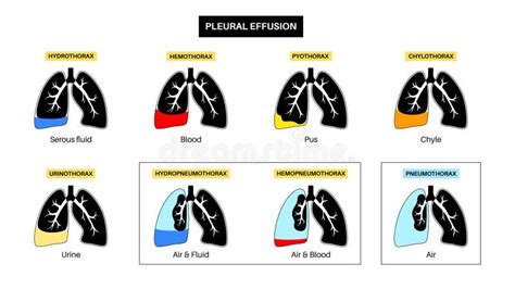 Pleural Effusion Poster Stock Vector Illustration Of Pleural 276163529