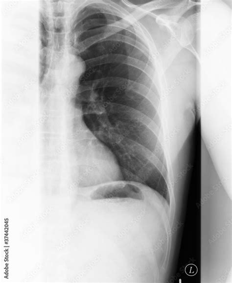 Röntgenbild Brustkorb Stock Foto Adobe Stock