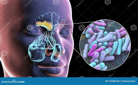 Sinusitis Inflammation Of Paranasal Cavities And Close Up View Of