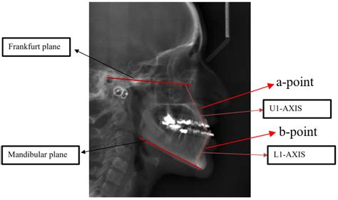 Comparative Assessment Of Perception About Angle Inclination Of