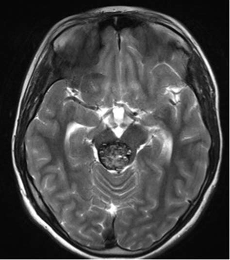 Midbrain Cavernous Malformation Presenting With Hydrocephalus