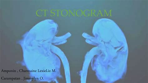 Ct Stonogram Final Slide Share Amponin And Carampatan Pptx