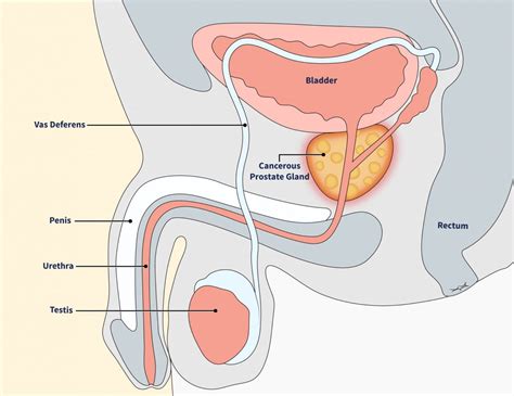 The Connection Between Prostate Cancer And Erectile Dysfunction