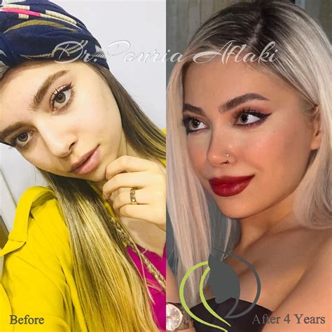 ‎جراحی بینی دکتر پوریا افلاکی‎ ‎چهارسال بعد از عمل ورق بزنید🌼