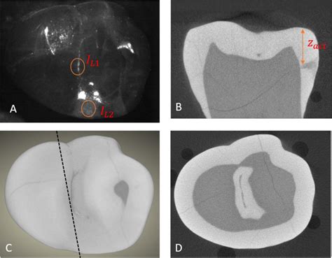 Interproximal Surface Of The Tooth Definition At Bennie Keim Blog