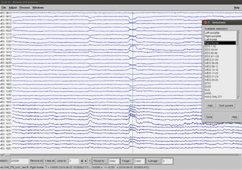 Artifacts In Meg Data Meg Wiki
