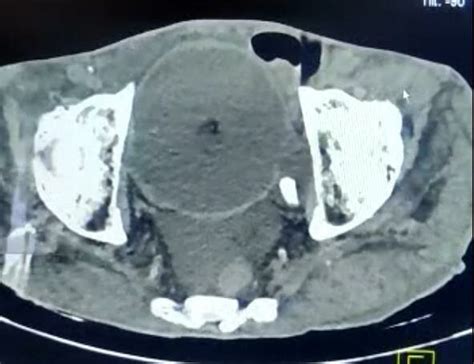 Plain Ct Image Of The Vesical Diverticular Calculus Download Scientific Diagram