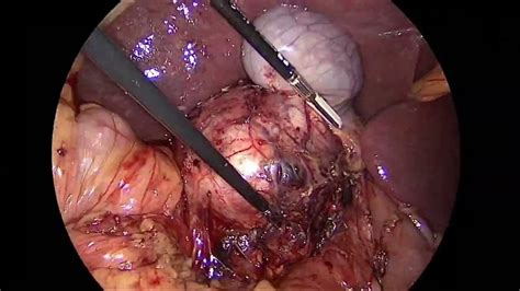 Laparoscopic Retro Peritoneal Leiomyosarcoma Excision Youtube