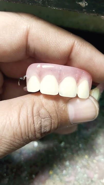 Upper 6 Unit Acrylic Partial Denture 😁😁😁 Youtube