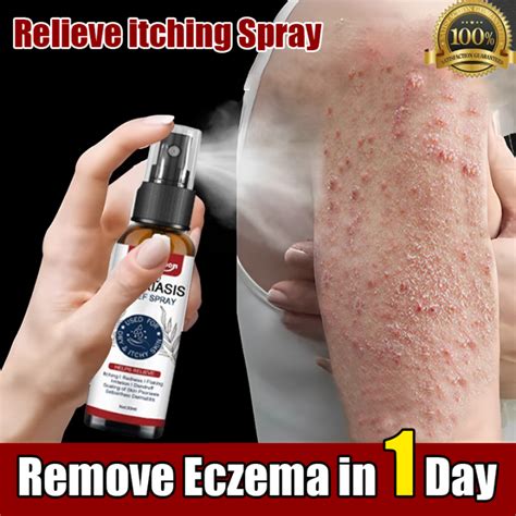 Eczema And Psoriasis Treatment Spray For Skin Diseases Antifungal Anti