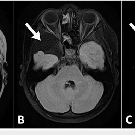 Axial Brain Mri Images Show A Lesion In The Right Middle Cranial Fossa