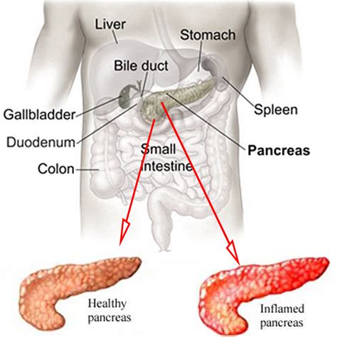 What Is Acute Pancreatitis And What Happens In Acute Pancreatitislpc