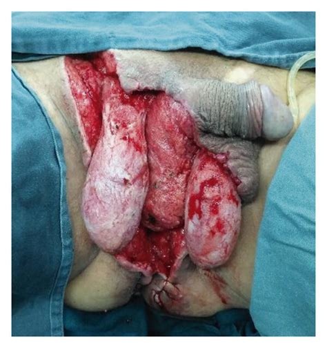 Surgical Debridement Procedure In A Patient With Nsti A F All Steps Download Scientific