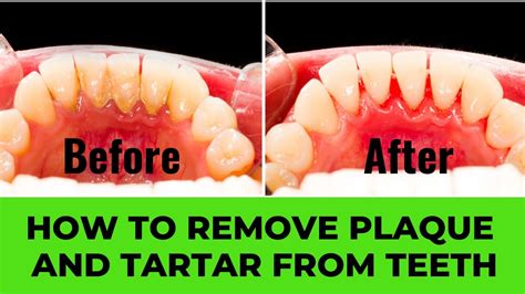 How To Remove Plaque And Tartar From Teeth Youtube