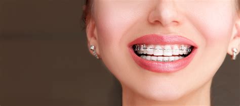Brackets Damon Sobre Este Tipo De Ortodoncia