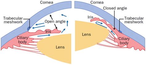 Anterior Chamber Angle