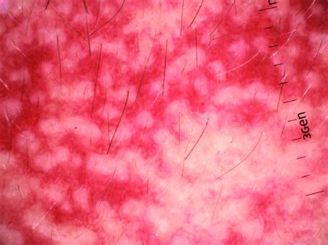 Dermoscopy Of Erythrosis Interfollicularis Colli Demonstrating A