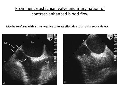 Ppt Contrast Echocardiography Powerpoint Presentation Free Download