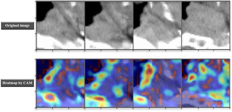 Feature Heatmaps Of Representative Patients On The Deep Learning Download Scientific Diagram