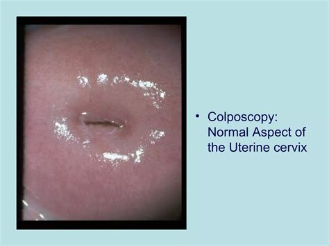 Pathology Of Cervix Ppt