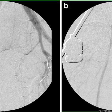 Pelvic Arteriogram Without Pelvic Arterial Contrast Extravasation A Download Scientific