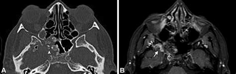 Anatomy And Diseases Of The Greater Wings Of The Sphenoid Bone