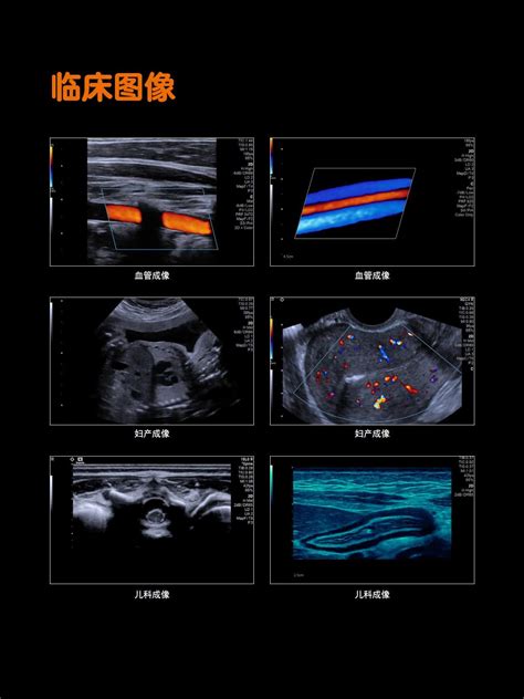 Acuson Sequoia Silver 超声诊断系统 西门子医疗系统有限公司