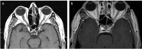 Mri Brain Of Patient And Control A T1 Axial Post Gadolinium Mr Image