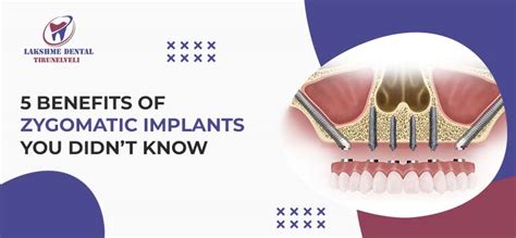 5 Benefits Of Zygomatic Implants You Didnt Know
