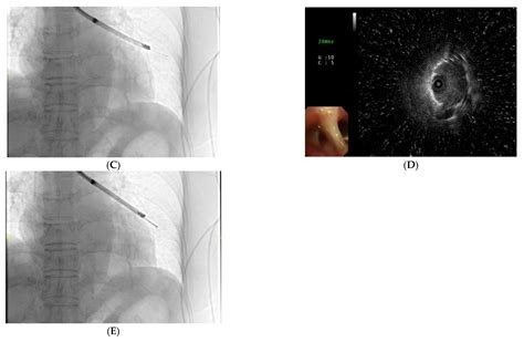 Cone Beam Computed Tomography Derived Augmented Fluoroscopy Improves
