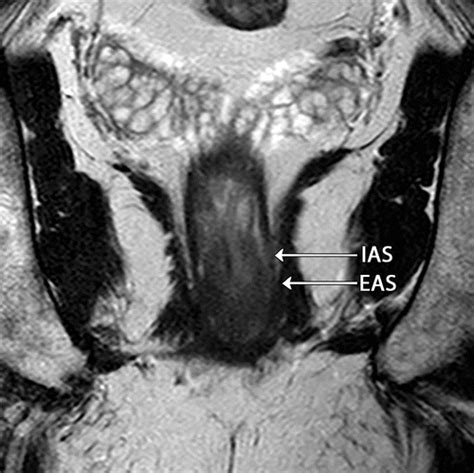 Mri Of The Male Pelvic Floor Radiographics