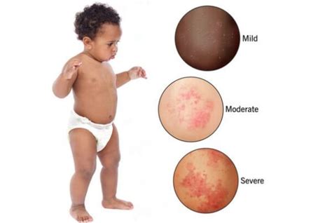 Understanding And Treating Different Types Of Baby Rashes ClickMotherCare