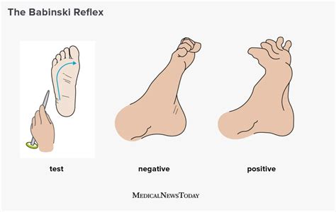 Describe The Response To The Plantar Stimulation Use Appropriate