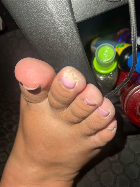 Dry Skin On Tip Of Toe Rdermatologyquestions
