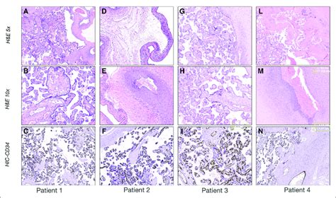 Sonographic Patterns Of Bronchodysplasia Bpd Representative Pictures