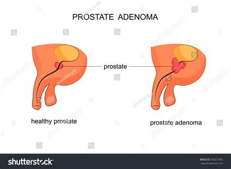 Vector Illustration Problems Andrology Publication Medical Stock Vector