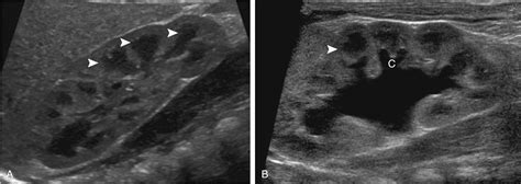 Imaging Approach To Urinary Tract Dilation Clinical Tree