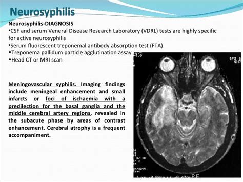 Short Presentation Version Cns Infections Lecture