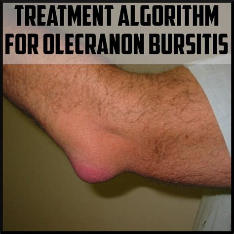 Treatment Algorithm For Olecranon Bursitis — The Sports Medicine Review